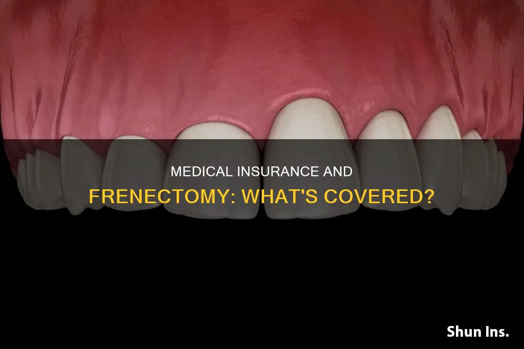 Medical Insurance And Frenectomy: What's Covered? | ShunIns
