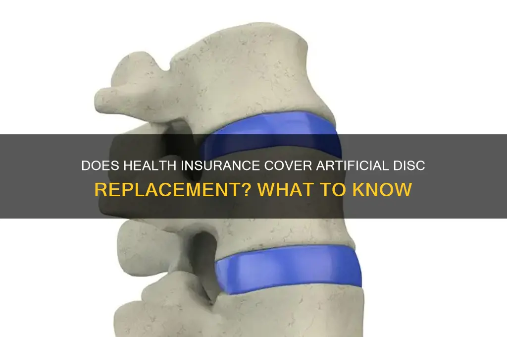 Does Health Insurance Cover Artificial Disc Replacement? What To Know ...