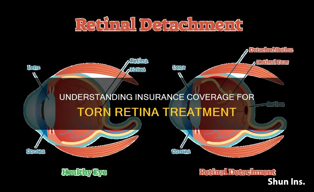 Understanding Insurance Coverage For Torn Retina Treatment | ShunIns
